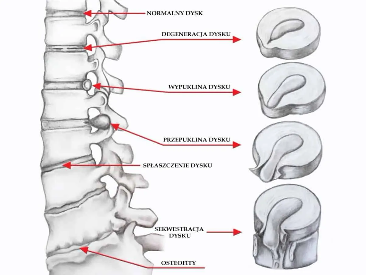 Dyskopatia: przyczyny, objawy i leczenie bólu kręgosłupa